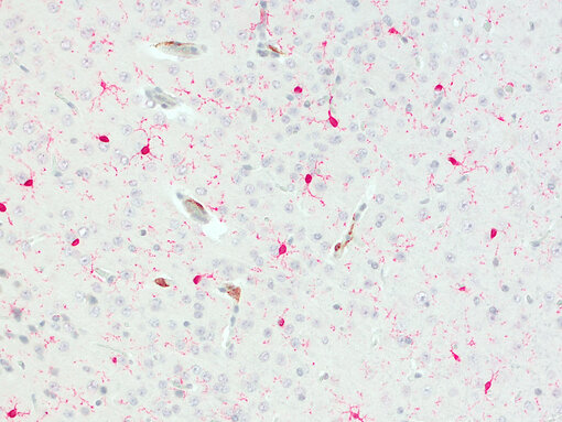 Battle in the Brain - Neuroinflammation